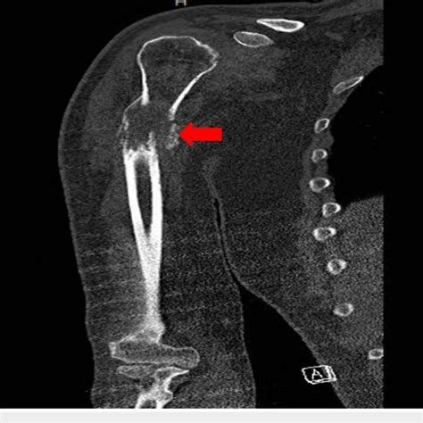 Computed Tomography Scan Of The Neck Showing A Necrotic Thyroid Mass Download Scientific