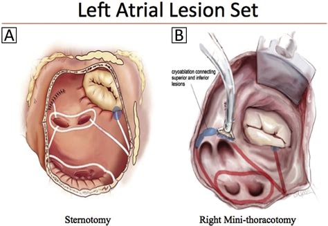 Elder Source Community Mini Maze Procedure Vs Catheter Ablation