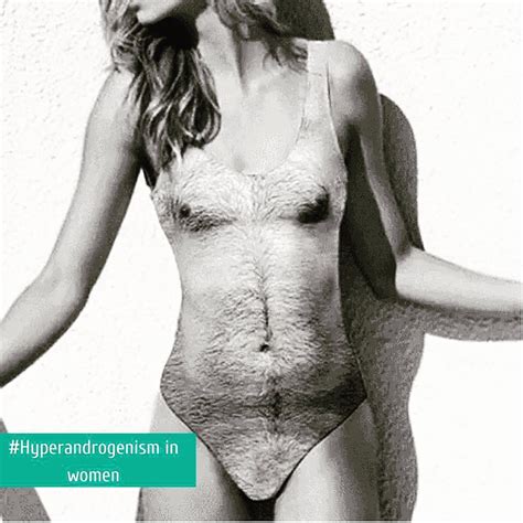 Medinet Hyperandrogenism Profoundly Affects Womens