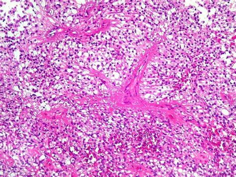 Clear Cell Ependymoma