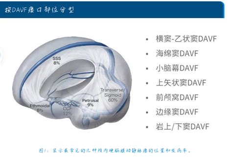 温医一院神经外科病例分享（16）：颅颈交界davf切除术1例 脑医汇