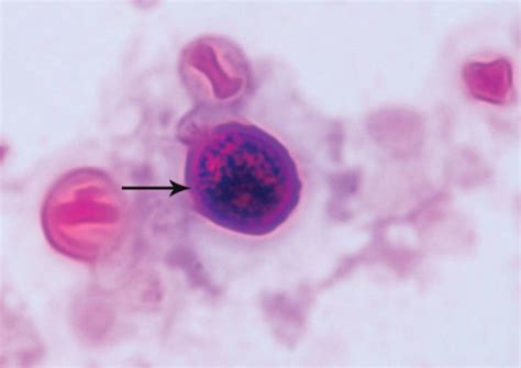 Cryptococcus Neoformans Gram Stain