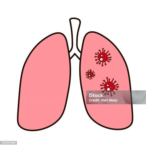 폐 질환 폐 렴 코로나 바이러스 독감 치료 질병의 확산 건강 상의 위험 바이러스의 전염병 다채로운 벡터 일러스트레이션입니다 흰색 배경에 격리된 요소입니다 건강관리와 의술에