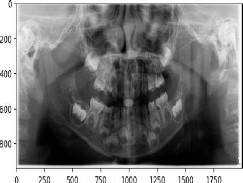 Figure 4 From Fast R Cnn Approaches For Transforming Dental Caries Detection An In Depth