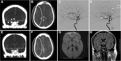 Vasospasm In Cerebral Arteries Secondary To Hypomagnesemia Coronal A