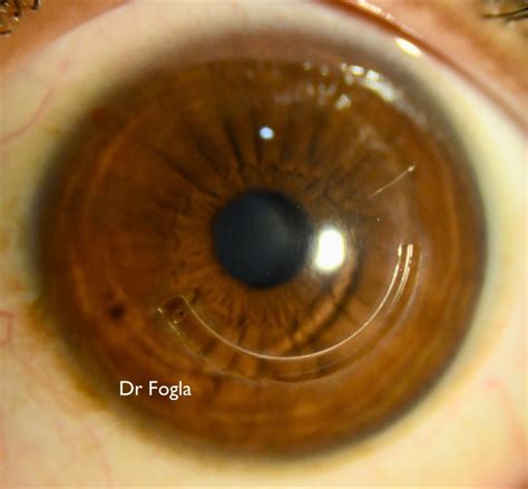 Rajesh Fogla On Linkedin Femtosecond Laser Assisted Intacs Implantation For Moderate Keratoconus…