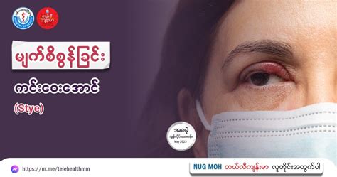 မျက်စိစွန်ခြင်း “ Stye” May 2023 တယ်လီကျန်းမာ