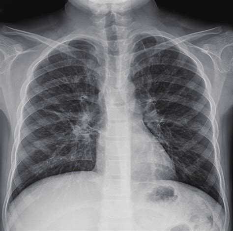 Chest X Ray Demonstrating Diffuse Bilateral Bronchiectasis Download
