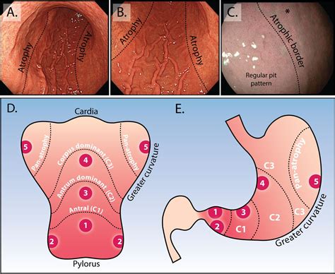 Endoscopy Stomach Cancer Images At Lee Porter Blog