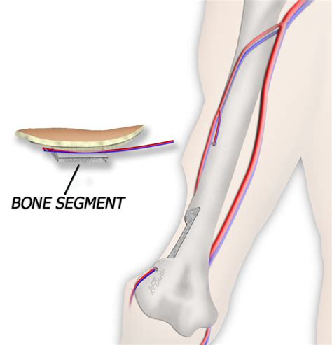 Lateral Arm Flap Anatomy At Zara Baillieu Blog