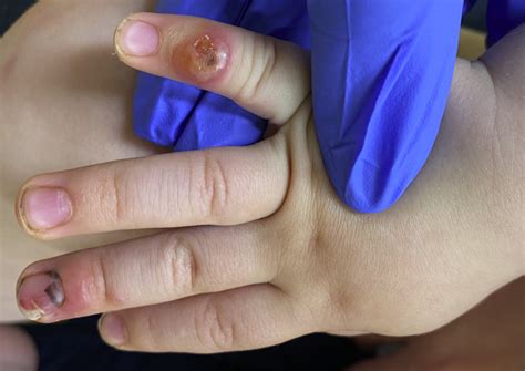 Erythematous Maculopapular Lesions Over The Distal Phalanxes Of The Download Scientific Diagram