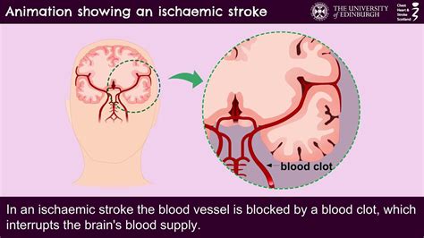 Ischemic Stroke Animation