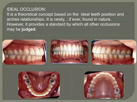 Classification Of Malocclusion Pptx