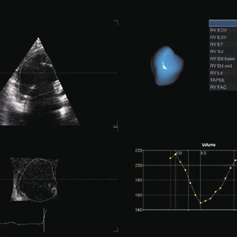 3d Quantification Of The Right Ventricular Ejection Fraction Download Scientific Diagram