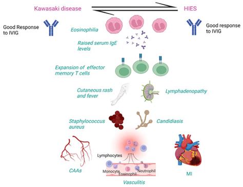 Diagnostics Free Full Text Kawasaki Disease And Inborn Errors Of