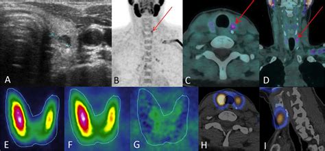 Persistent Primary Hyperparathyroidism After A First Upper Left Download Scientific Diagram