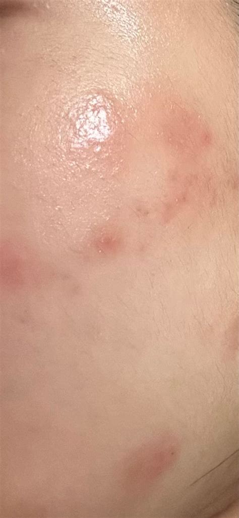 피부 빨간 흉터 지식in