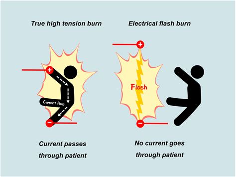 Distinction Between True Hightension Burn And Electrical Flash Burn Download Scientific Diagram