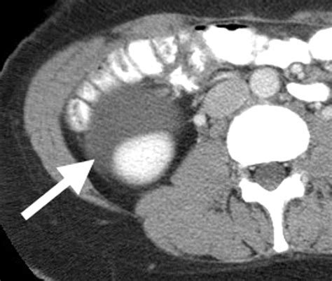 Symptomatic Perirenal Serous Cysts Of Müllerian Origin Mimicking Renal Cysts On Ct Ajr
