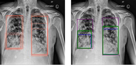 figure 1 from rsna pneumonia detection challenge winning model