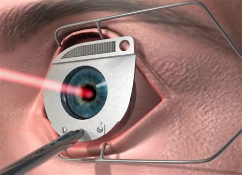 Коррекция зрения