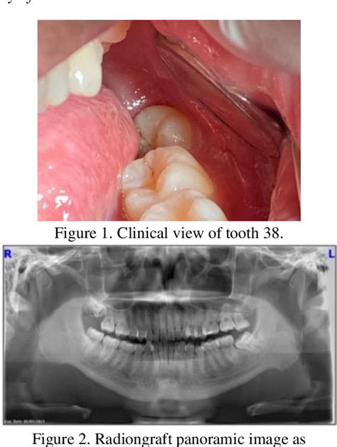 Figure 1 From Evaluation Effect Dexamethason And Paracetamol Post
