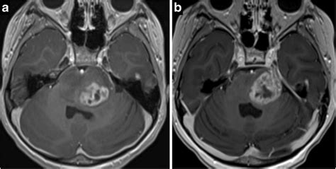 Neuroimaging Of Meckels Cave In Normal And Disease Conditions Insights Into Imaging Full Text
