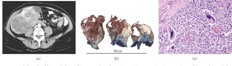 Figure 1 From Intrahepatic Sarcomatoid Cholangiocarcinoma Semantic Scholar