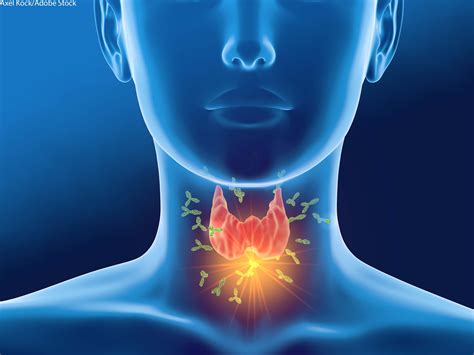 Limiting Complete Thyroidectomy Post Hemithyroidectomy Total
