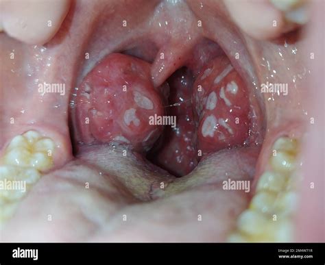 Bad Tonsillitis How To Get Rid Of Tonsil Stones Tonsil Stone Removal