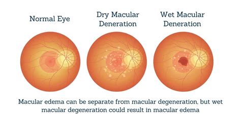 Macular Edema