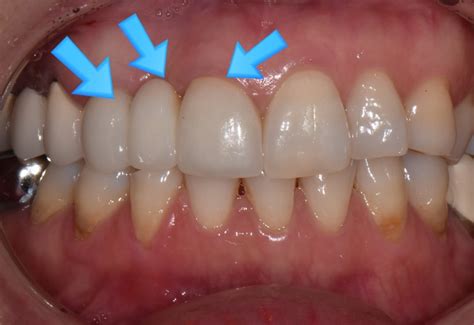 앞니 임플란트 임시치아 앞니 재치료 및 수명 네이버 블로그