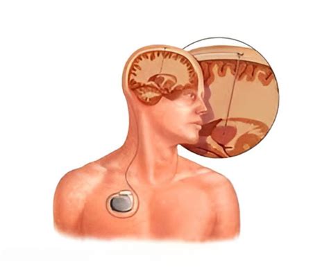 Deep Brain Stimulation Expert Care By Dr Sandeep Vaishya