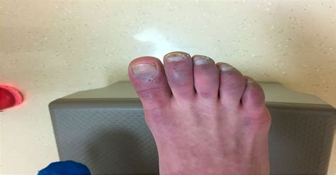 موقع الطبي ما هو سبب إزرقاق إصبع القدم أو متلازمة إصبع القدم الأزرق
