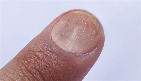 Nail Pitting What It Looks Like Causes And Treatment