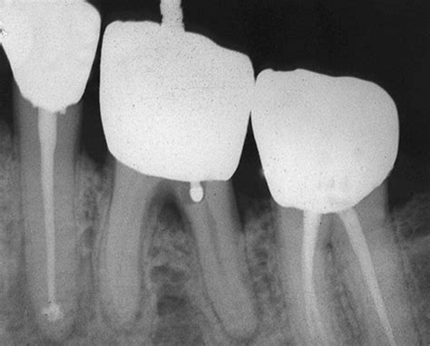 7 Use Of Mta As Root Perforation Repair Pocket Dentistry