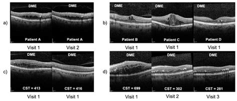 Ophthalmic Biomarker Detection Highlights From The Ieee Video And