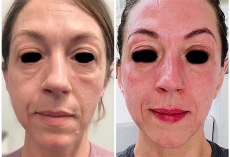 Microneedling Before And After Undereye Help [anti Aging] R Skincareaddiction
