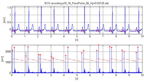 detection of pace pulses in pure ecg signal the first subplot