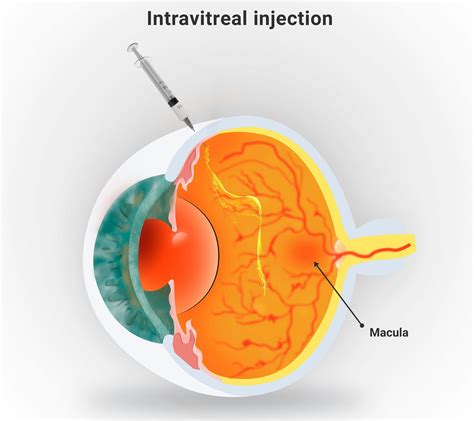 Guidelines For Suprachoroidal Space Injection Technique Defined By Panel Of Experts
