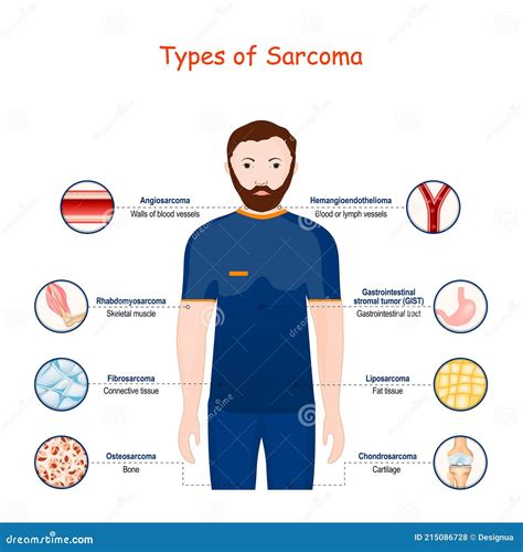 Sarcoma Types Of A Malignant Tumor Stock Vector Illustration Of Connective Pathology 215086728