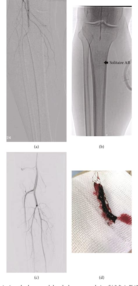 Figure 1 From Solitaire™ Stent Thrombectomy System In The Treatment Of