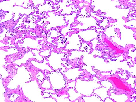 Diffuse Alveolar Wall Fibrosis Sometimes “interstitial” Fibrosis Download Scientific Diagram