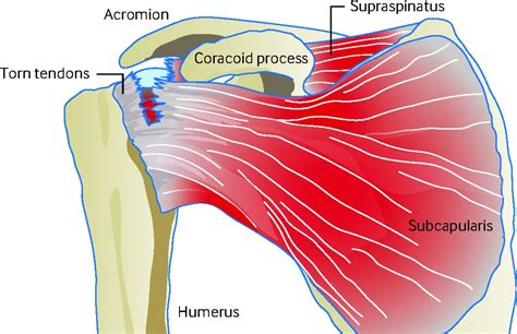Acute Rotator Cuff Tears The Bmj
