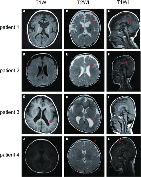 Different Sequence Of The Brain Mri Of The Affected Individuals A C