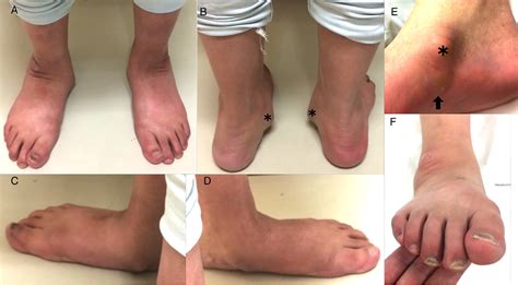 Adult Flat Foot With Multiple Accessory Navicular Bones Treated