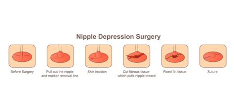 Nipple Procedures Durham Plastic Surgery