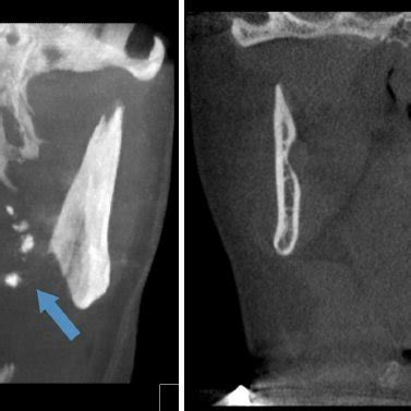 A Arrows Point To Bilateral Calcification Of The Choroid Plexuses In A Download Scientific