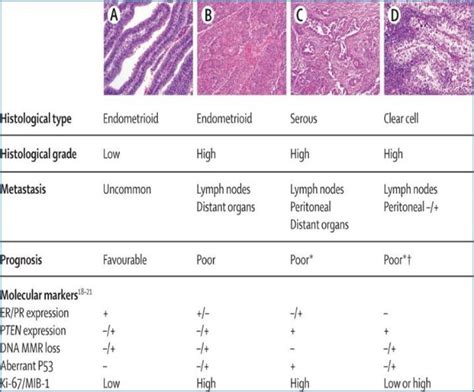 Histological Types Of Endometrial Carcinoma 19 Download Scientific Diagram