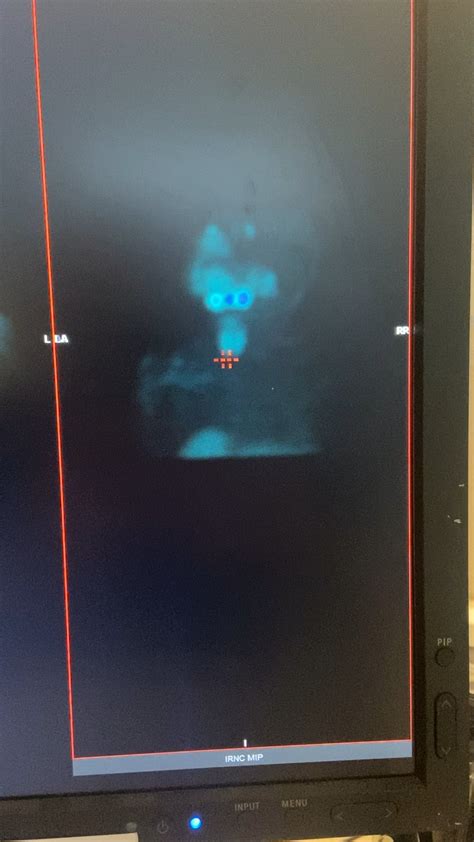 Parathyroid Scan 2 Of 2 R Nuclearmedicine